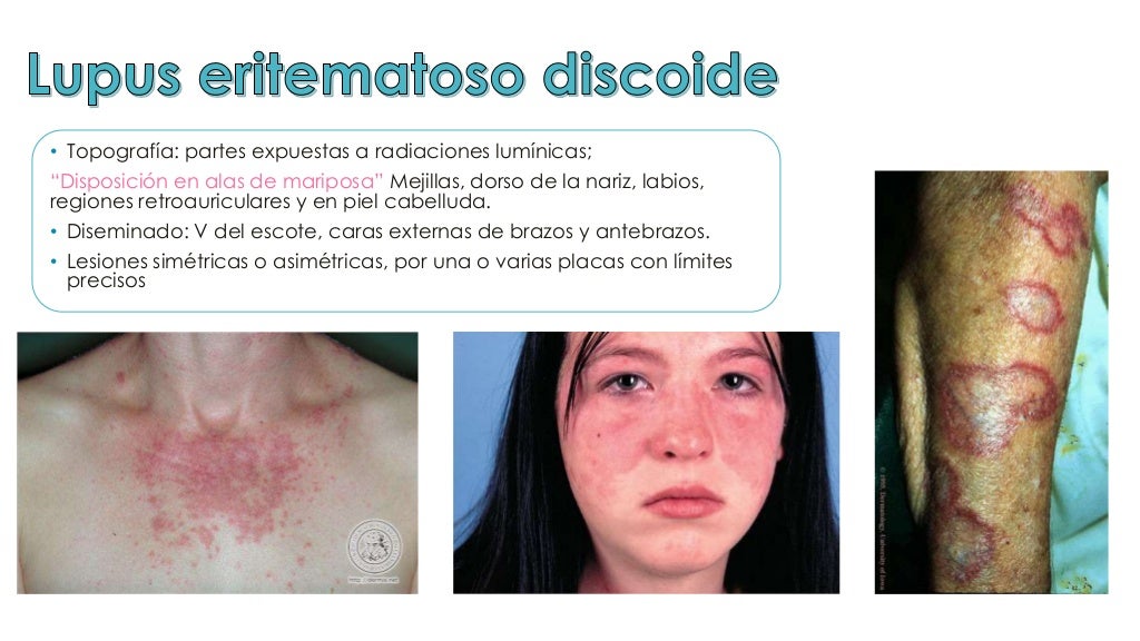 Lupus eritematoso discoide