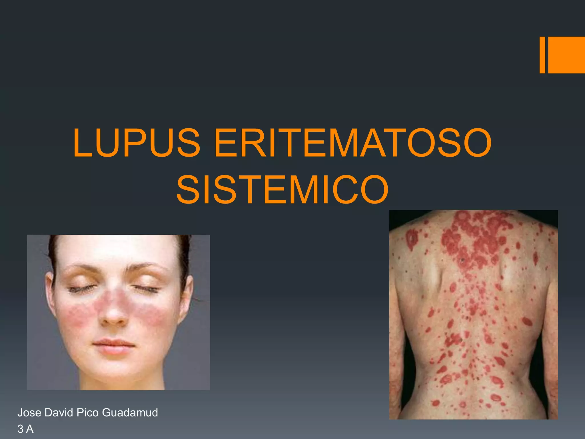 Lupus eritematoso sistemico | PPT