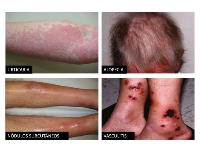 LES (Lupus Eritematoso Sistémico)