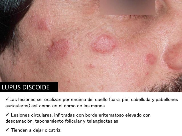 LES (Lupus Eritematoso Sistémico)