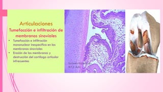 Lupus eritematoso sistémico | PPTX