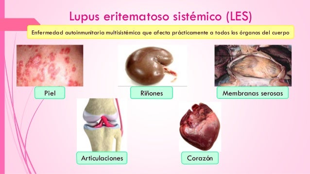 Lupus eritematoso sistémico