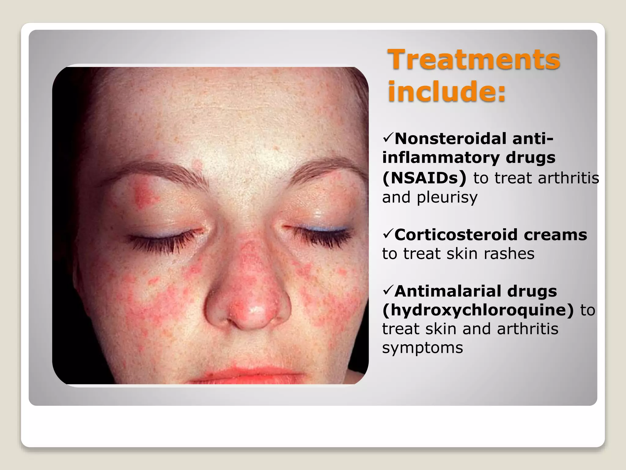 Lupus erythematosis | PPT