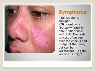 Lupus erythematosis | PPT