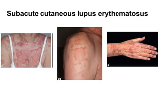 Lupus erythematosus, Clinical Features and Management | PDF