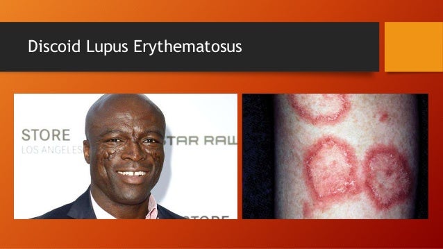 Lupus erythematosus. Slide Share