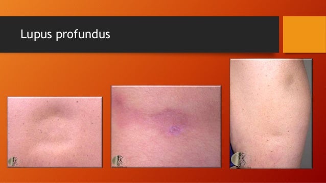 Lupus erythematosus. Slide Share