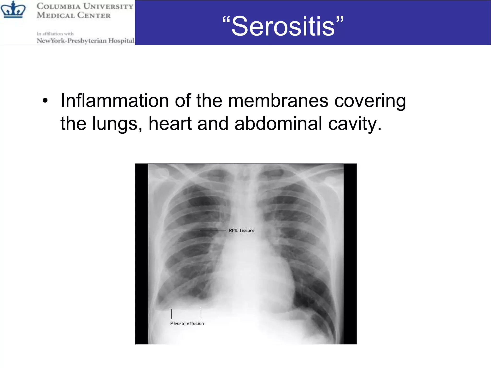 Lupus foundation educational program 2013 | PPTX