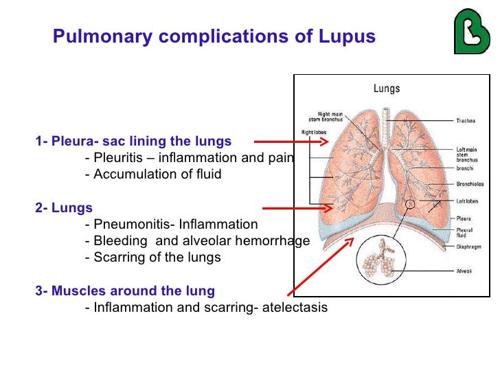 Lupus and the Lungs by Dr. Gilda Diaz-Fuentes