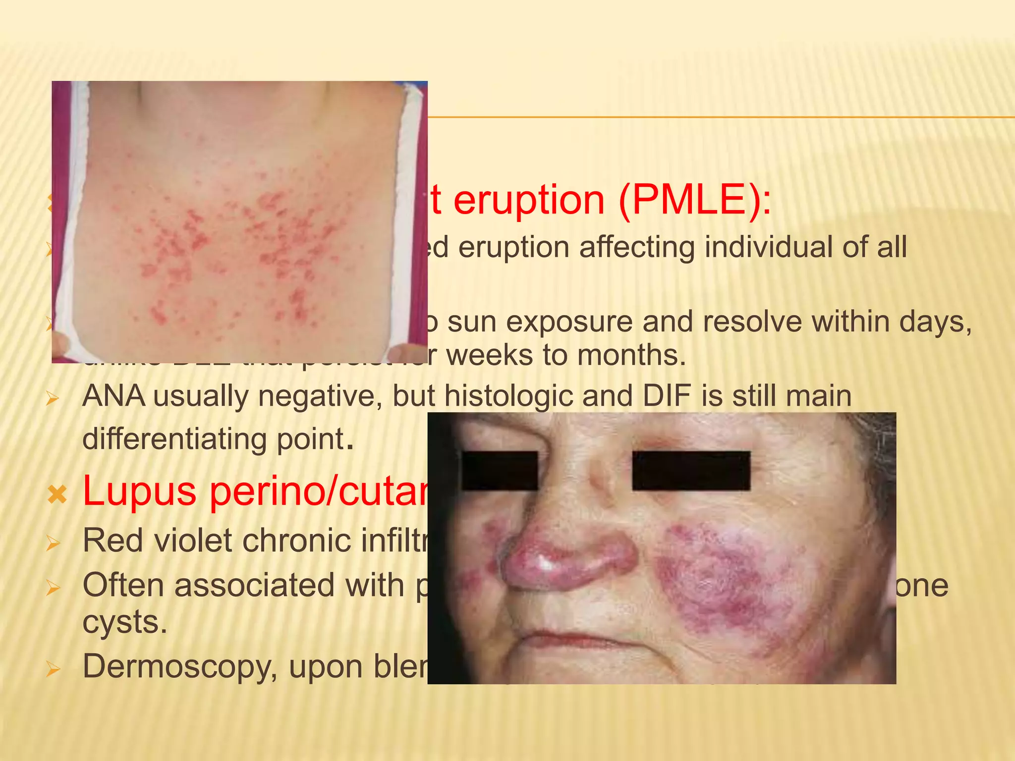 Lupus mimicker2.pptx