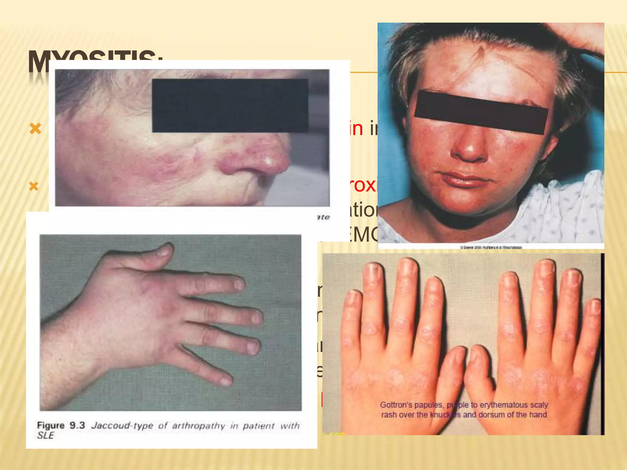 Lupus mimicker2.pptx