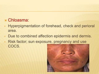Lupus mimicker2.pptx