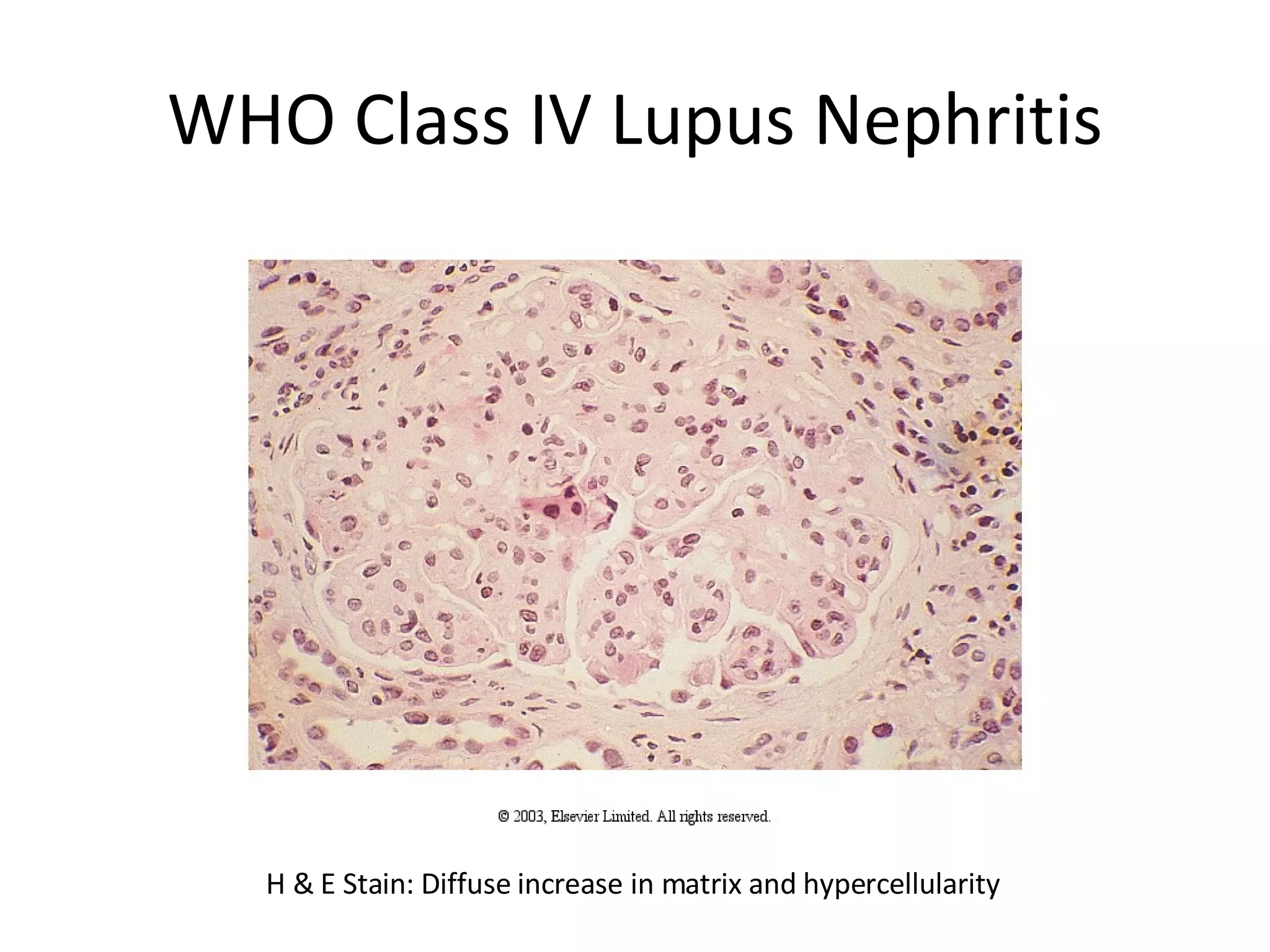 Lupus Nephritis | PPT