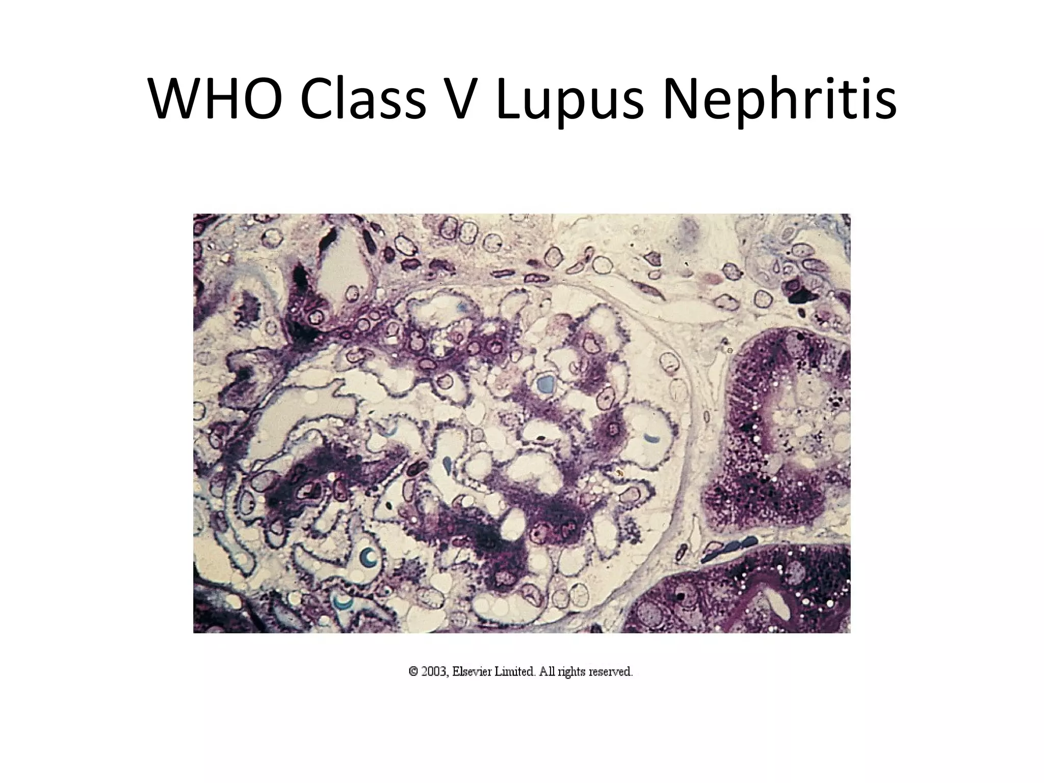 Lupus Nephritis | PPT