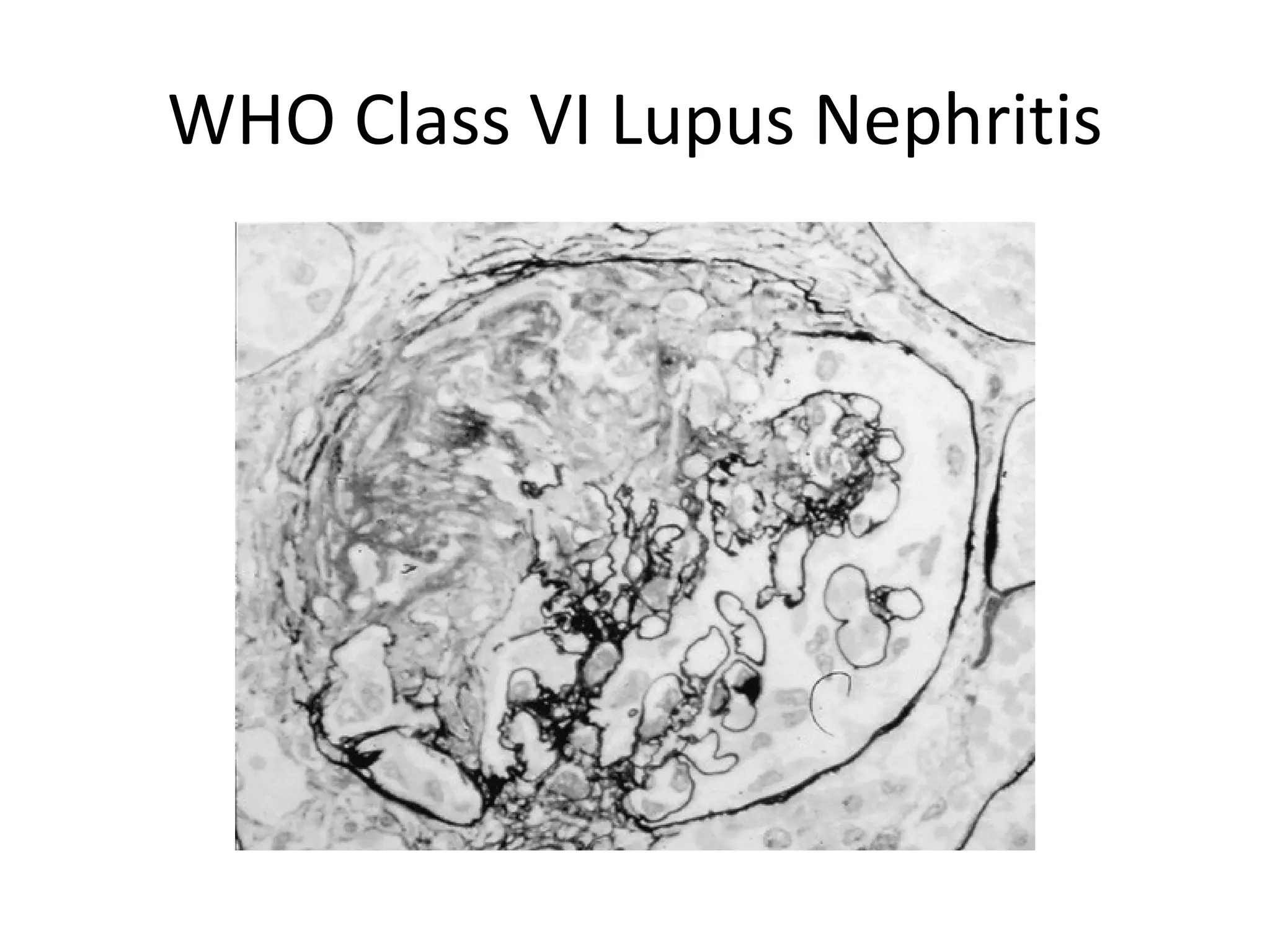 Lupus Nephritis | PPT