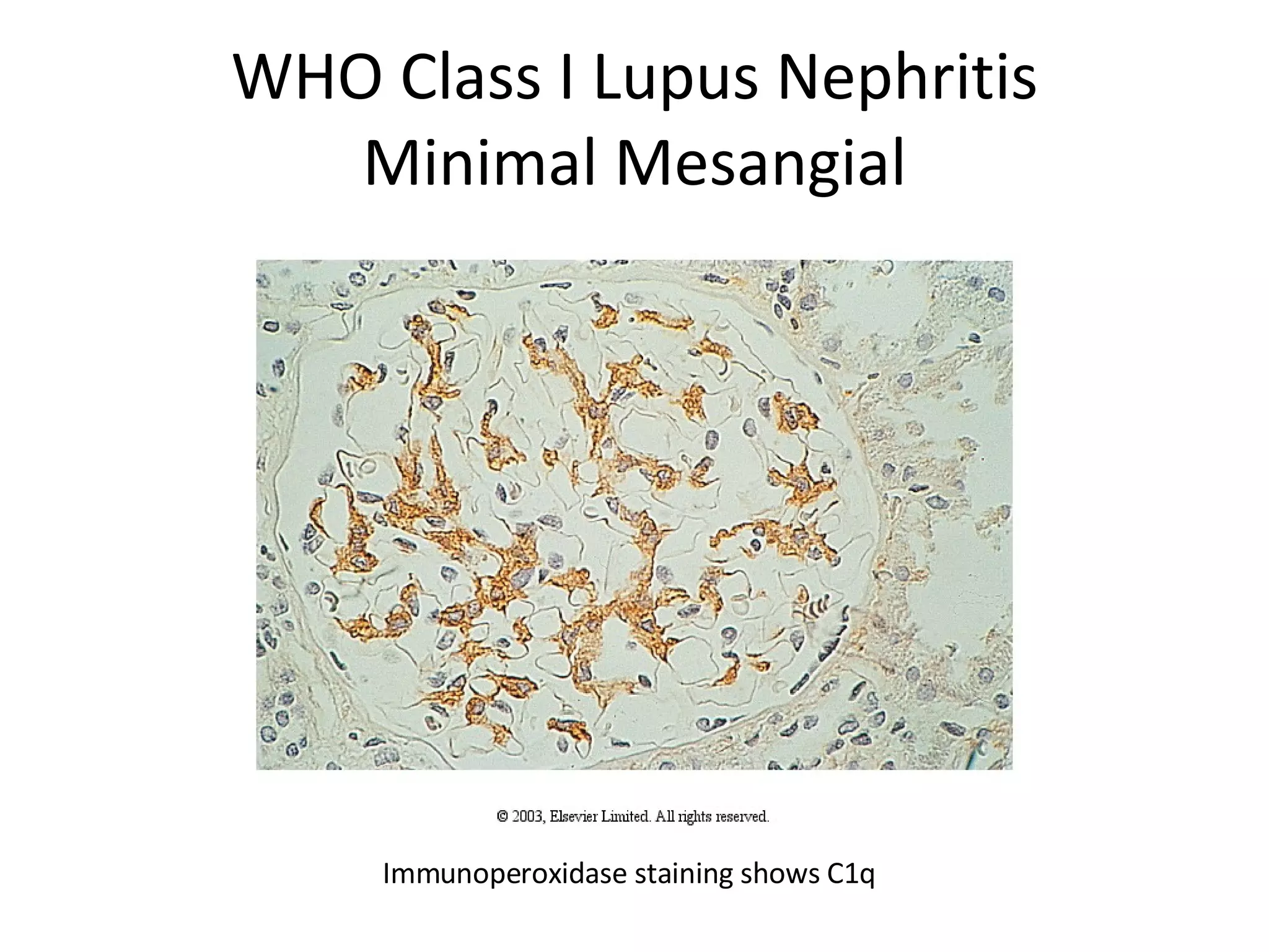 Lupus Nephritis | PPT