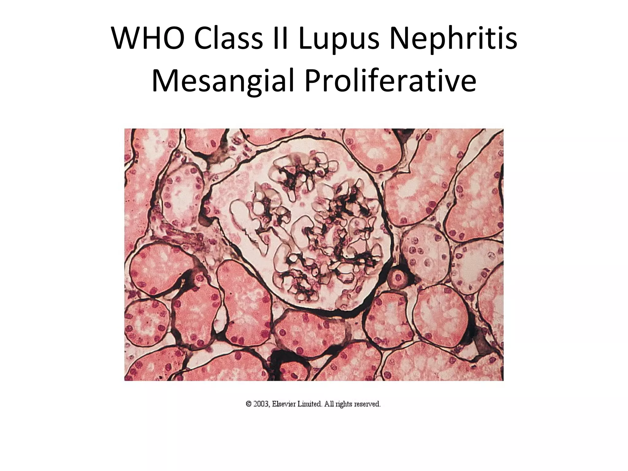 Lupus Nephritis | PPT