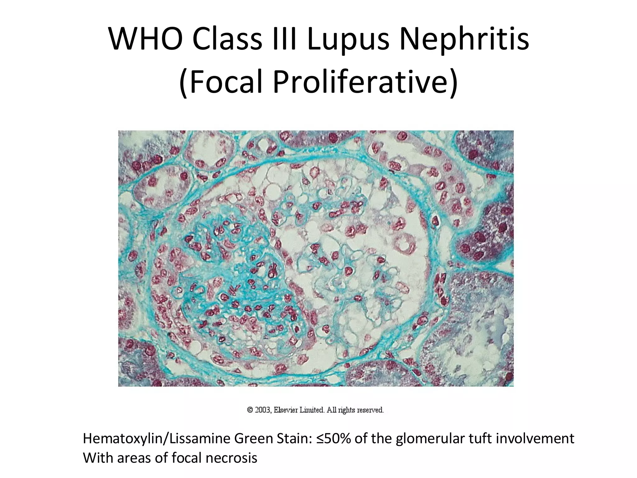 Lupus Nephritis | PPT