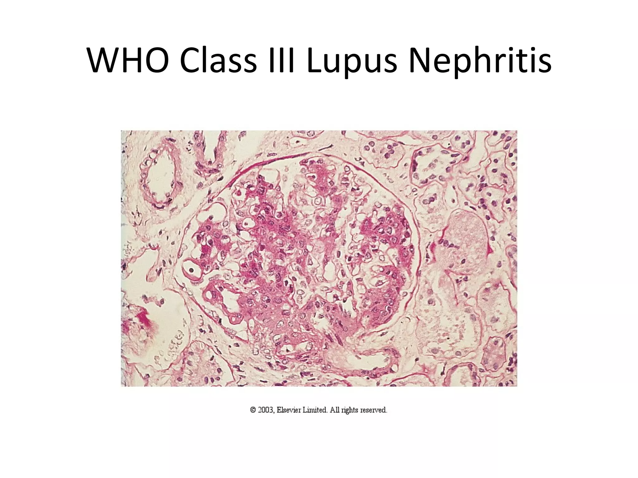 Lupus Nephritis | PPT