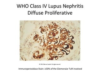 Lupus Nephritis | PPT