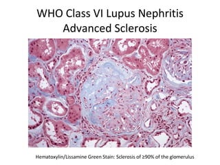 Lupus Nephritis | PPT