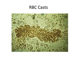 Lupus Nephritis | PPT