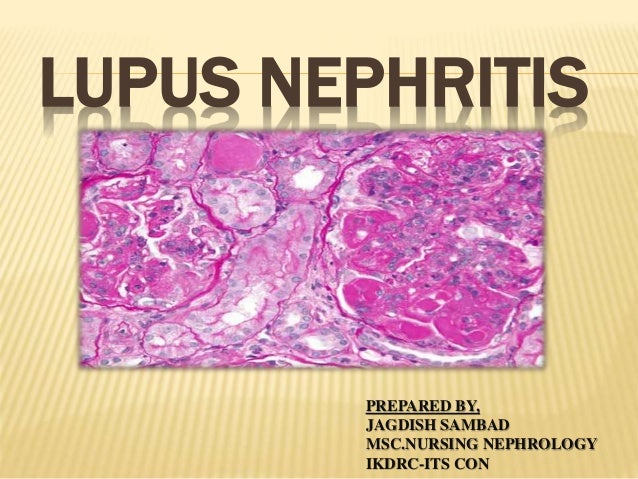 Lupus nephritis