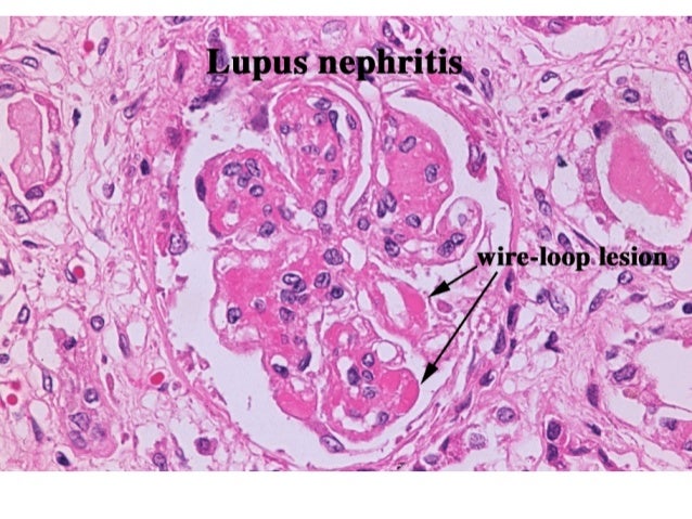 Lupus nephritis by dr saddique 2