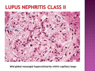 Diffuse Proliferative Glomerulonephritis Wire Looping