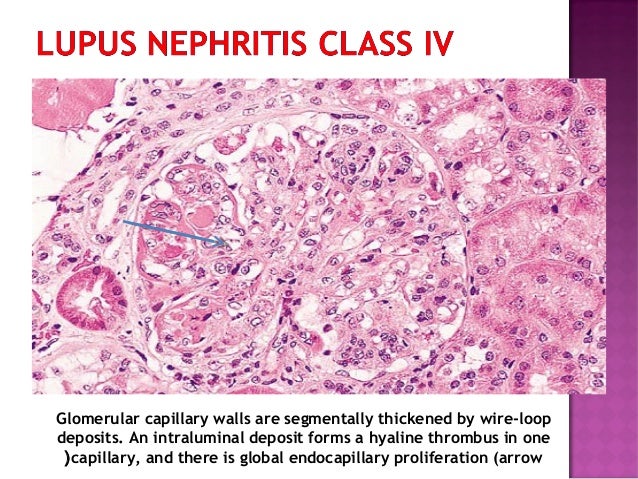 Lupus nephritis post fff