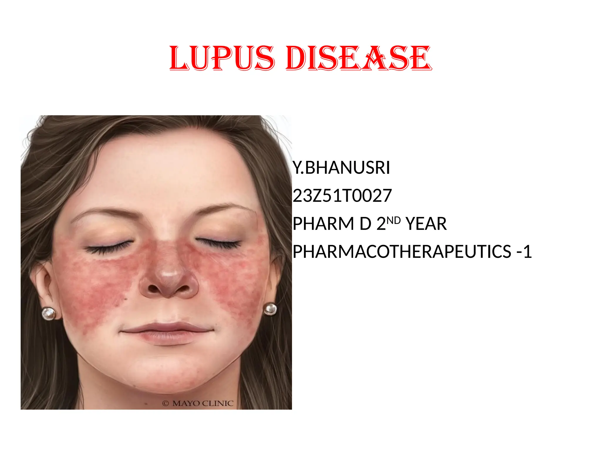 lupus disease _ pptx presentationon | PPT