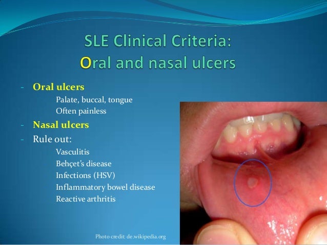 Lupus update for Primary Care Providers 2014