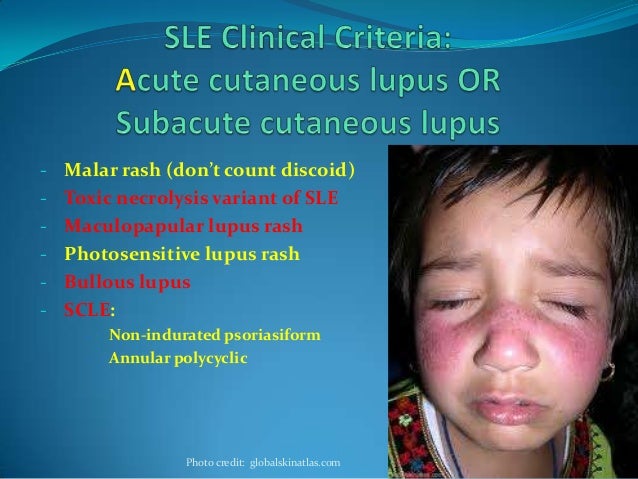 Lupus Malar Rash Treatment Bimalar Facial Rashes Clinical Advisor