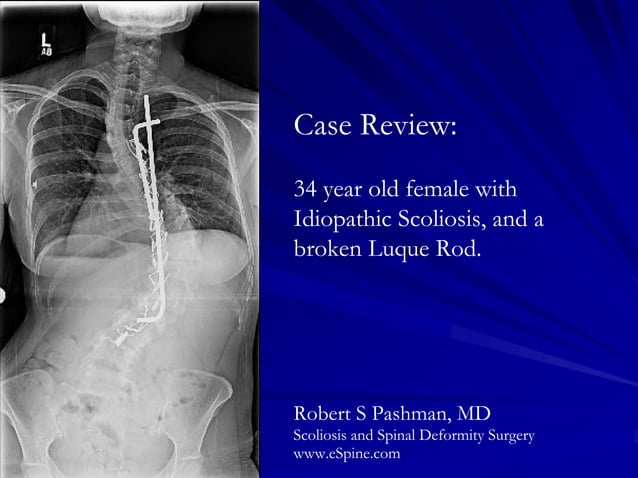 Case Review #36: 34 year old female with Adult Idiopathic Scoliosis and ...