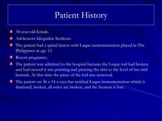 Case Review #36: 34 year old female with Adult Idiopathic Scoliosis and ...