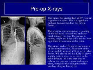 Case Review #36: 34 year old female with Adult Idiopathic Scoliosis and ...