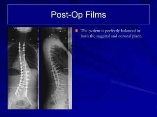 Case Review #36: 34 year old female with Adult Idiopathic Scoliosis and ...