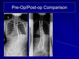 Case Review #36: 34 year old female with Adult Idiopathic Scoliosis and ...