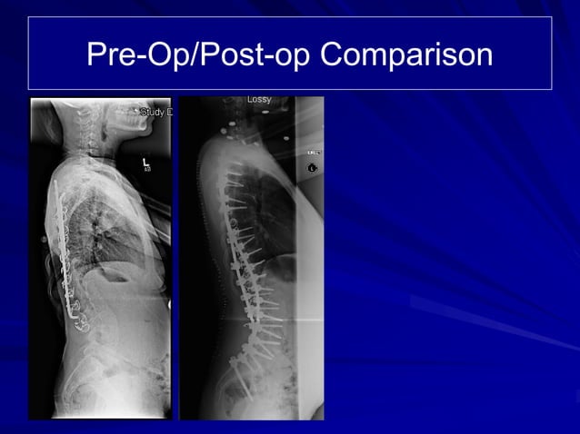 Case Review #36: 34 year old female with Adult Idiopathic Scoliosis and ...