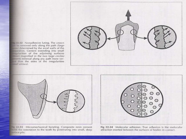LUTING AGENTS | PPT | Dental Health | Diseases and Conditions