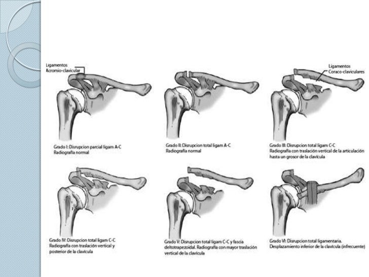 Luxación acromioclavicular