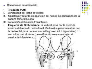 Luxación Congénita de Cadera | PPT