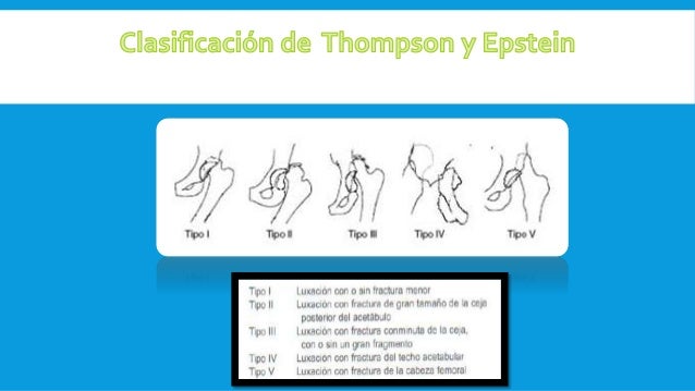 Luxación de cadera y fracturas de la cabeza