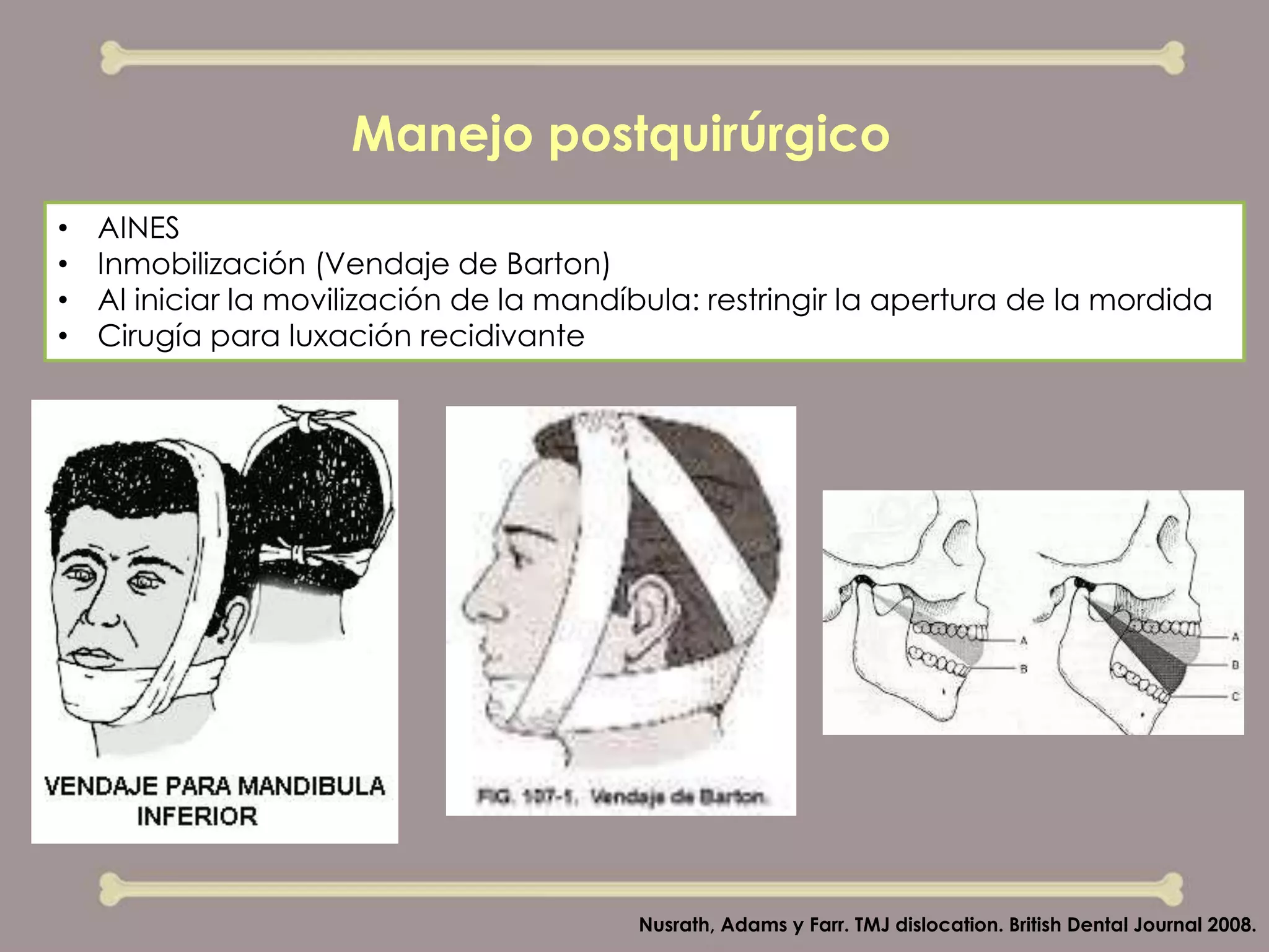 Luxación mandibular | PPTX