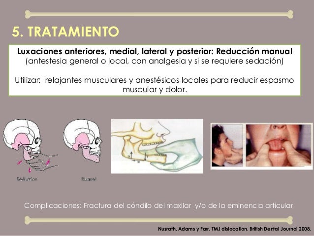 ¿Por Qué Una Dislocación O Luxación Mandibular? – XSZY