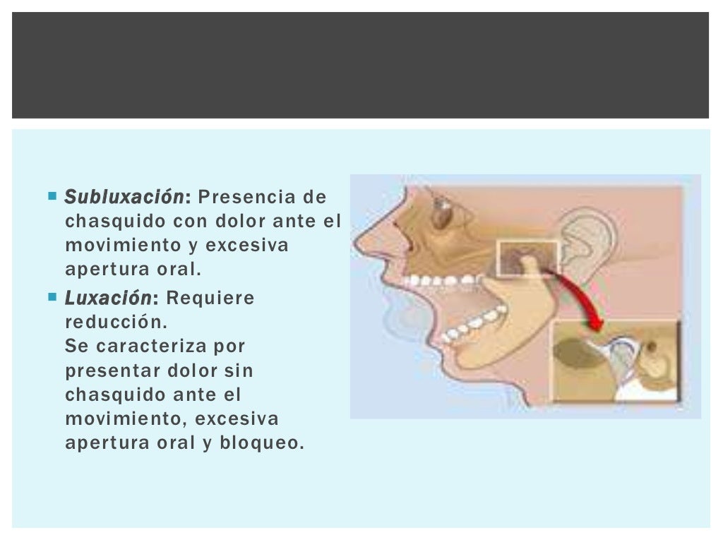 Luxación y subluxación temporomandibular