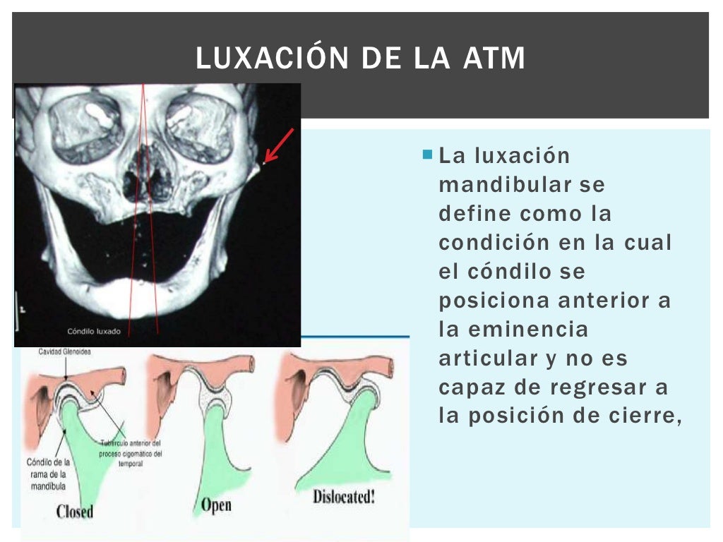 Luxación y subluxación temporomandibular