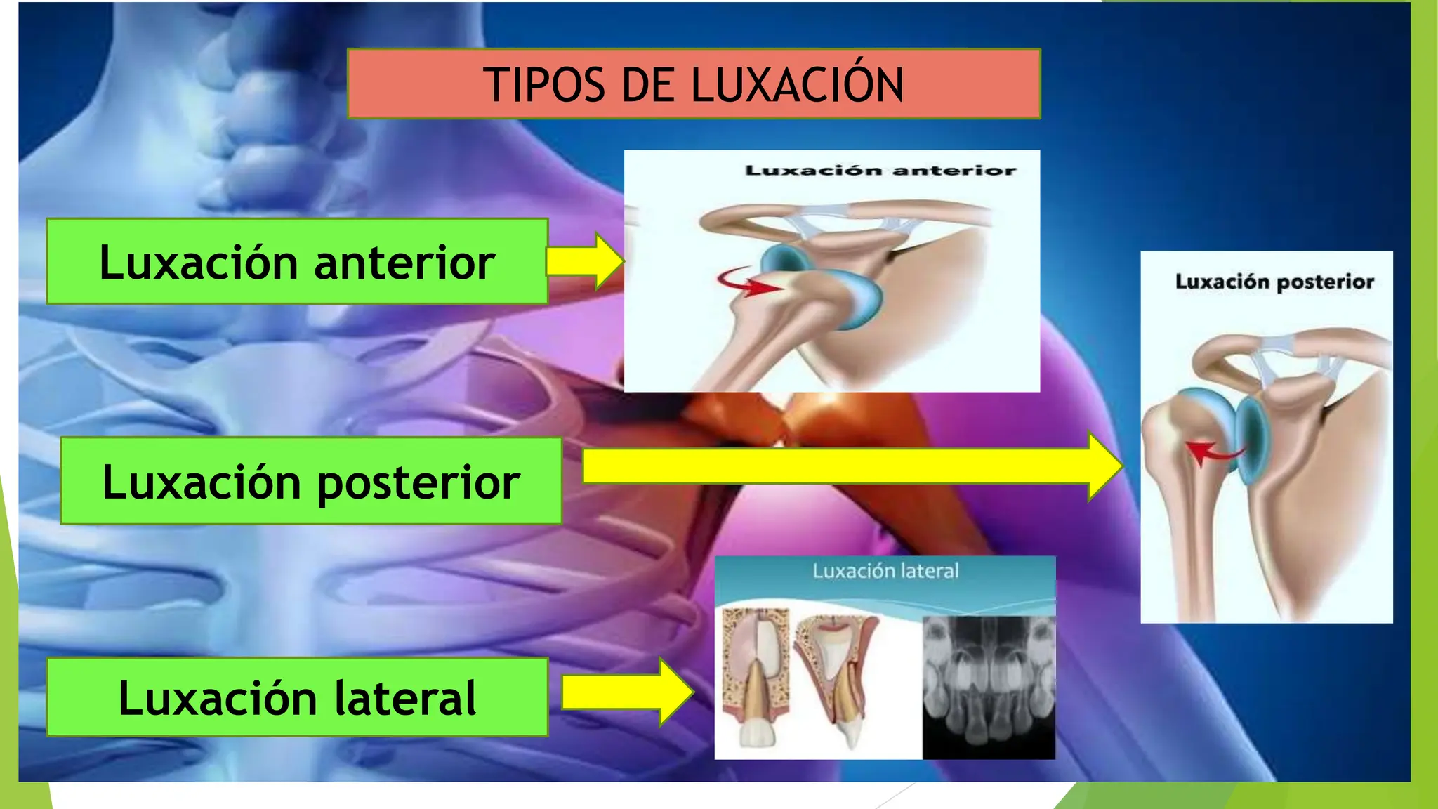 LUXACIONES Y TIPOS DE LUXACIONES Y TRATAMIENTO | PPTX | Bone and Joint ...