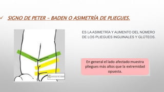 LUXACION CONGÉNITA. un trabajo de enfermería pptx | PPTX