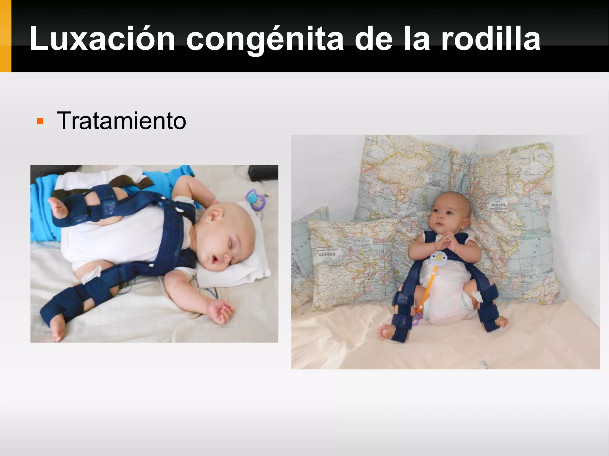 Luxacion congenita de la rodilla